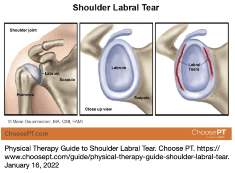 SLAP Tears in Rock Climbers' Shoulder - The Climbing Doctor